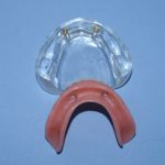 Loc-2 Lower denture w/attachments. – Leemark Dental